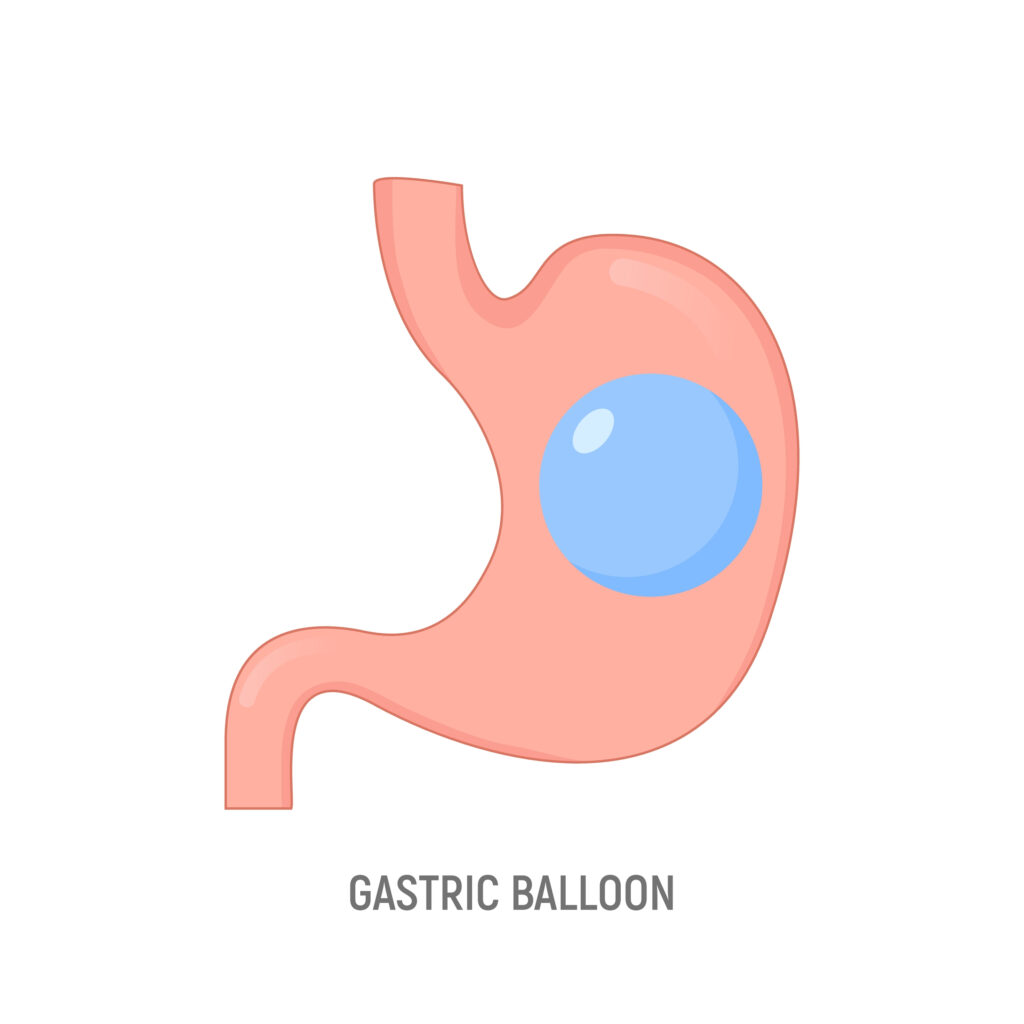 Which Gastric Balloon Brands Lead the Market and How Do You Pick the ...